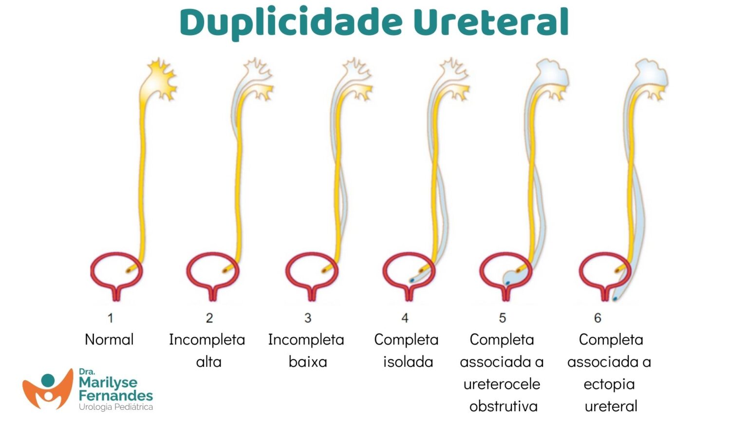 Conheça a duplicidade ureteral: fatores, riscos e cuidados
