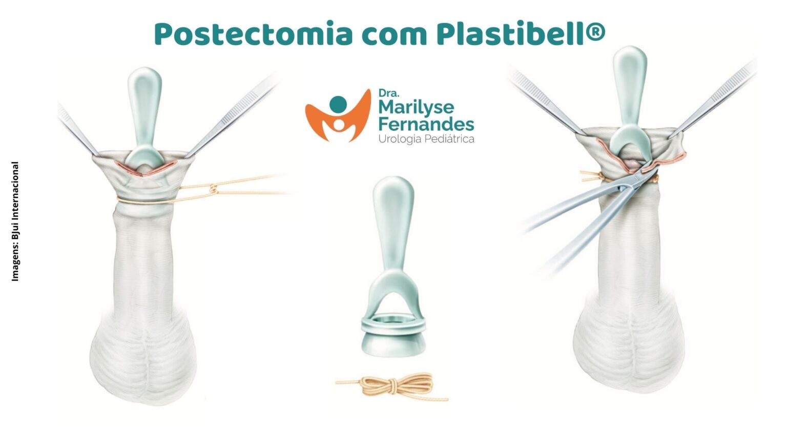 Fimose: Como identificar, tratar e prevenir complicações