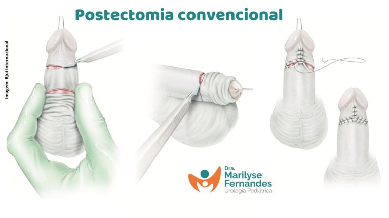 Fimose: Como identificar, tratar e prevenir complicações