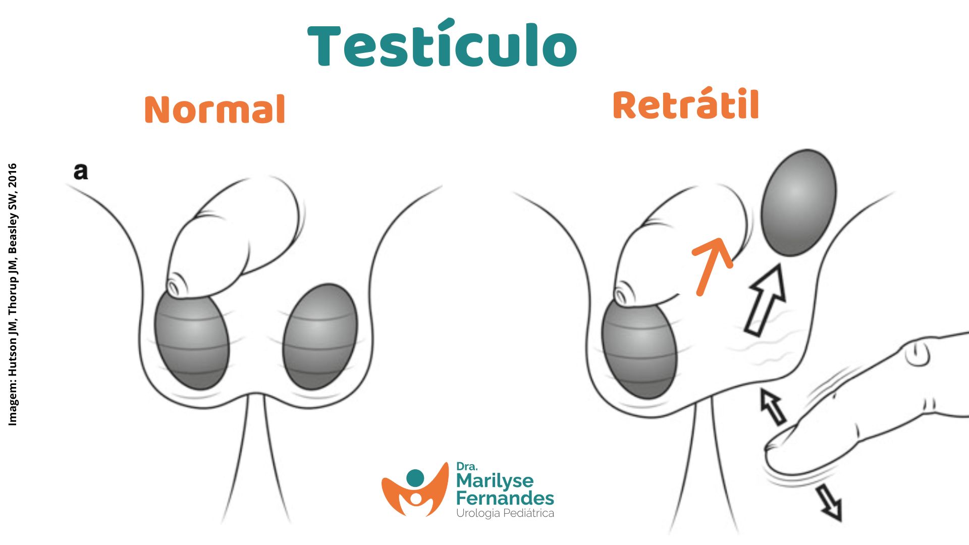 Testículo retrátil em crianças: como identificar e tratar?