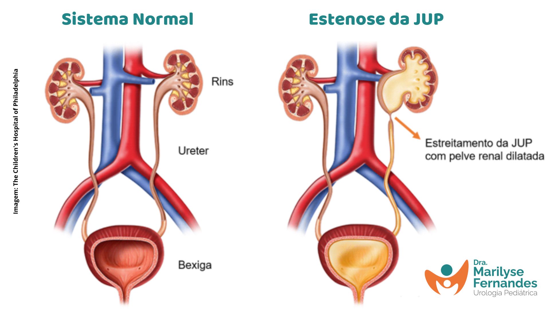 Estenose de JUP: compreendendo suas causas e sintomas