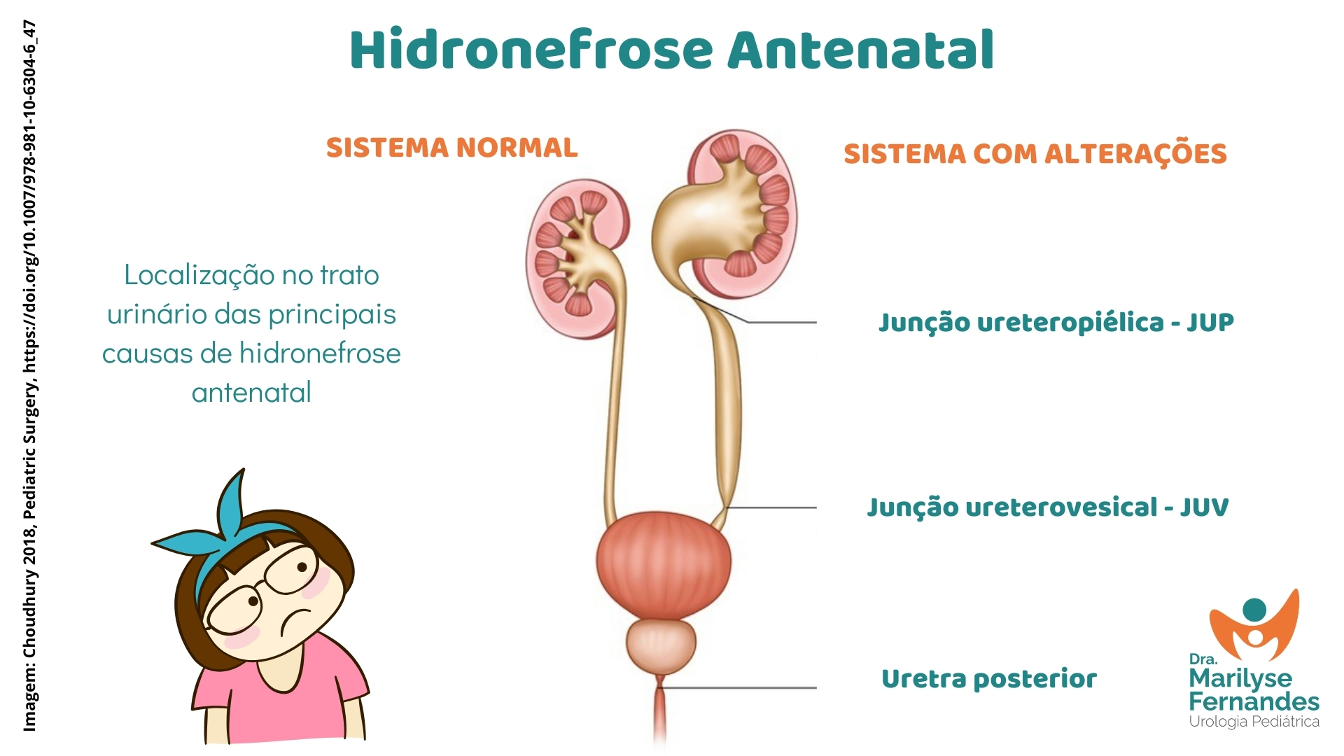 Hidronefrose antenatal: causas, diagnósticos e tratamentos