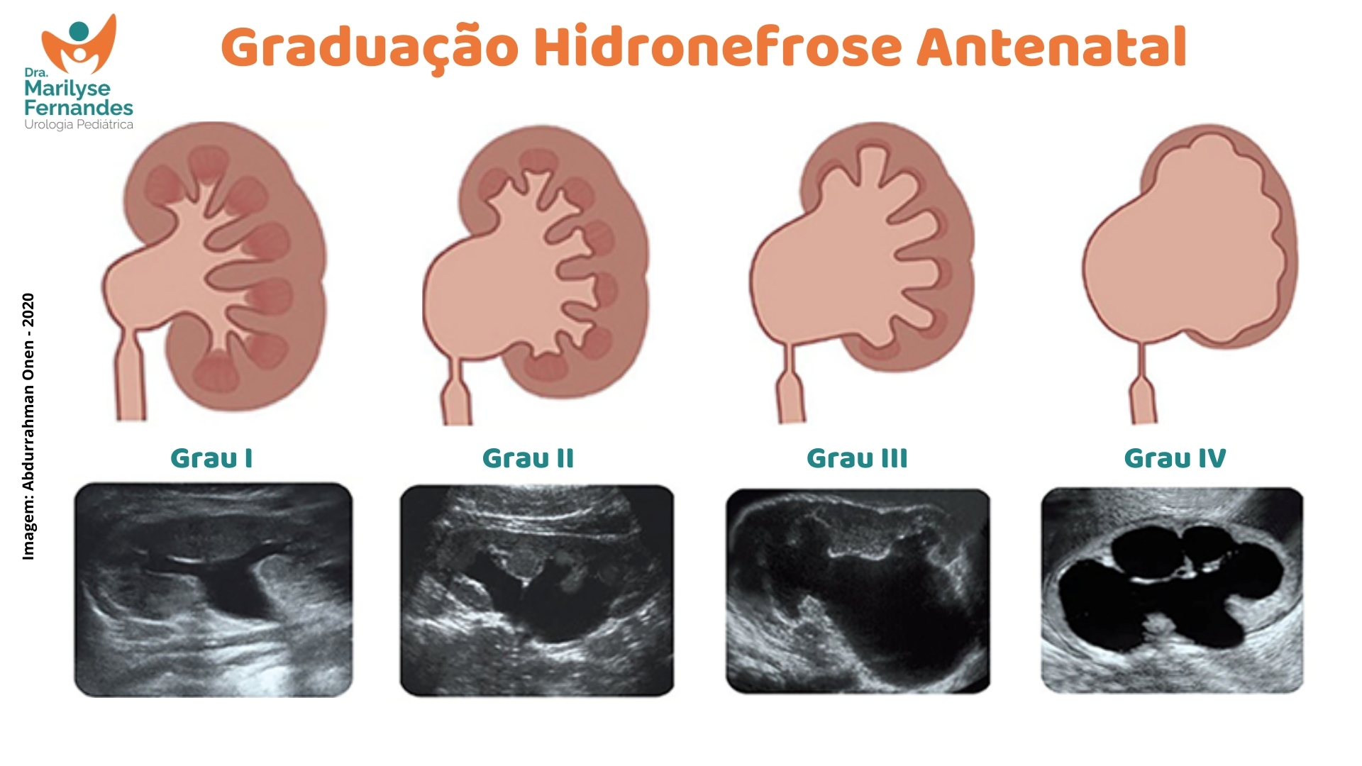 Hidronefrose antenatal: causas, diagnósticos e tratamentos