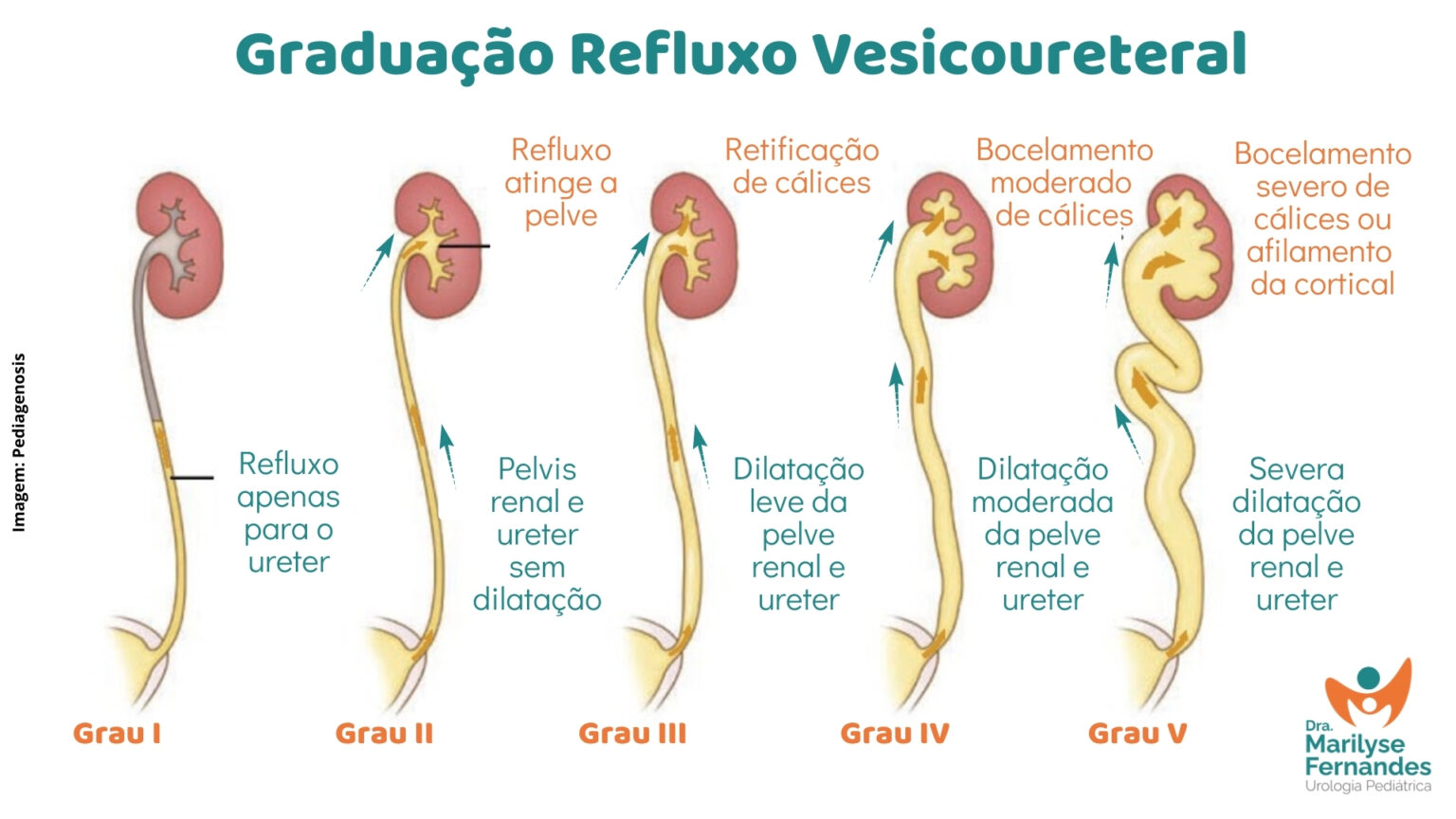 O que é refluxo vesicoureteral e como afeta a saúde renal?