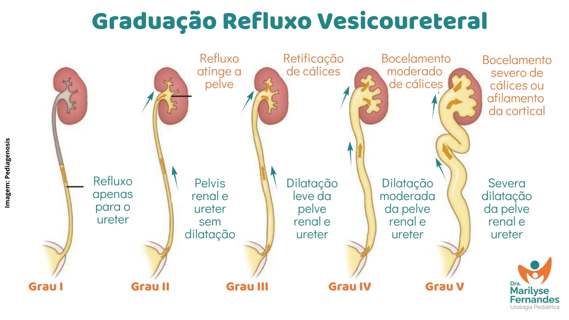 O que é refluxo vesicoureteral e como afeta a saúde renal?